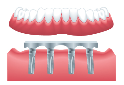What Are Implant Anchored Dentures | Spring Lake Dental Care